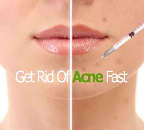 Acne Injection - Bellair Laser Clinic